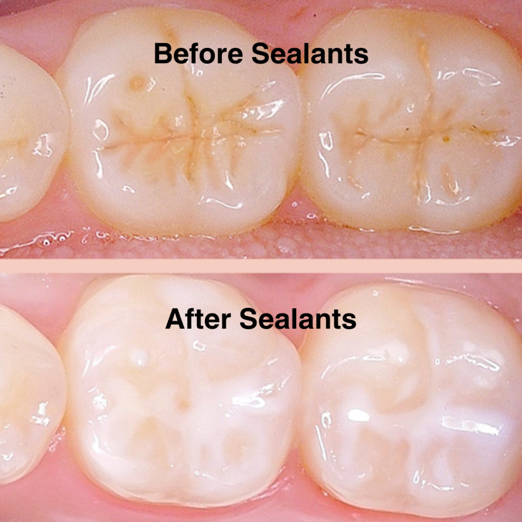 Protect Your Child’s Smile: The Benefits of Dental Sealants | Meadowmont Dentistry | Dentist in ...