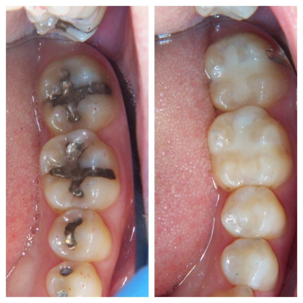 The Importance of Replacing Old Silver Fillings | Meadowmont Dentistry ...