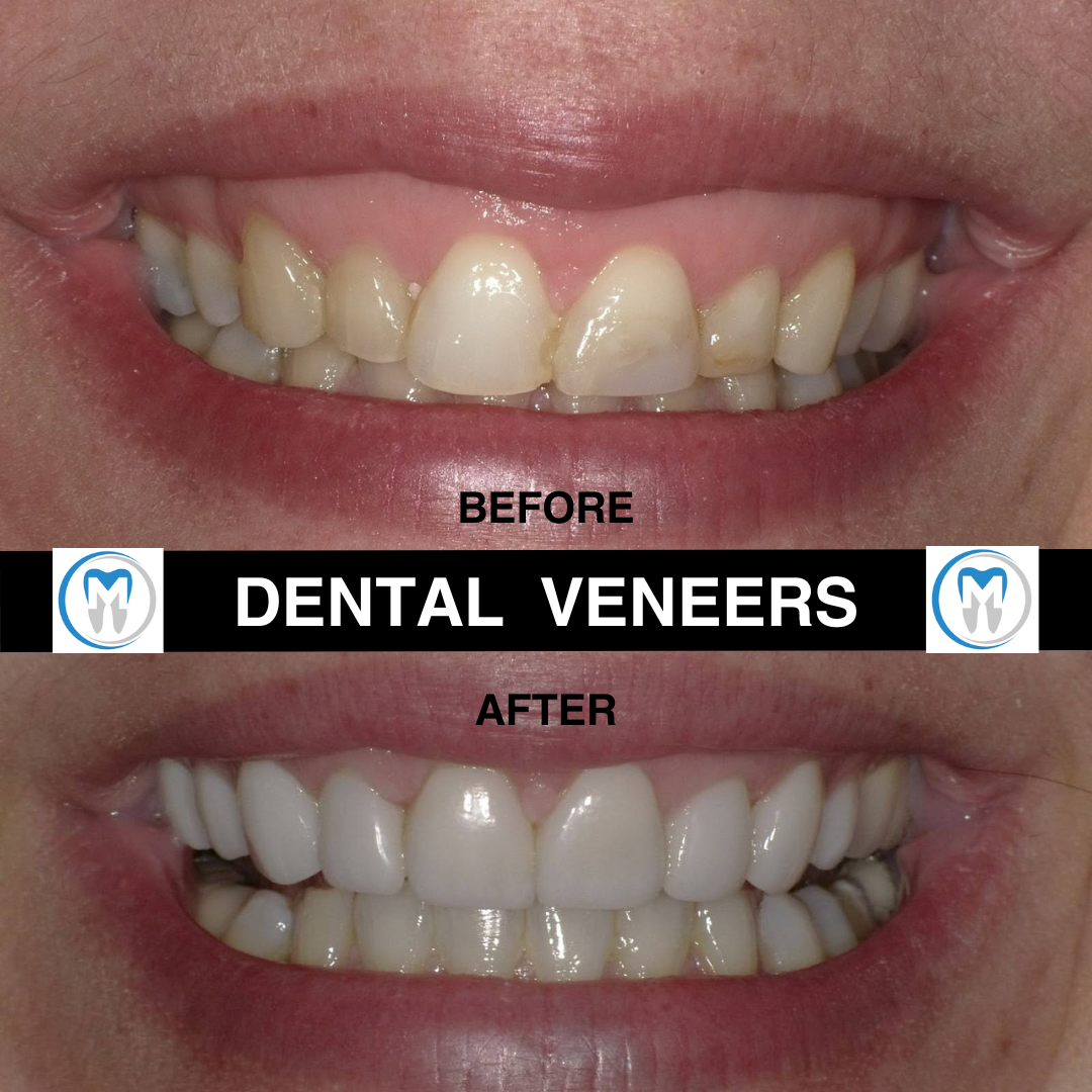 Transform Your Smile with Dental Veneers | Meadowmont Dentistry ...